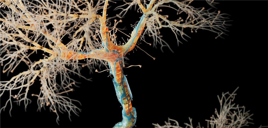 Eine Mononeuritis multiplex ist ein Warnsignal