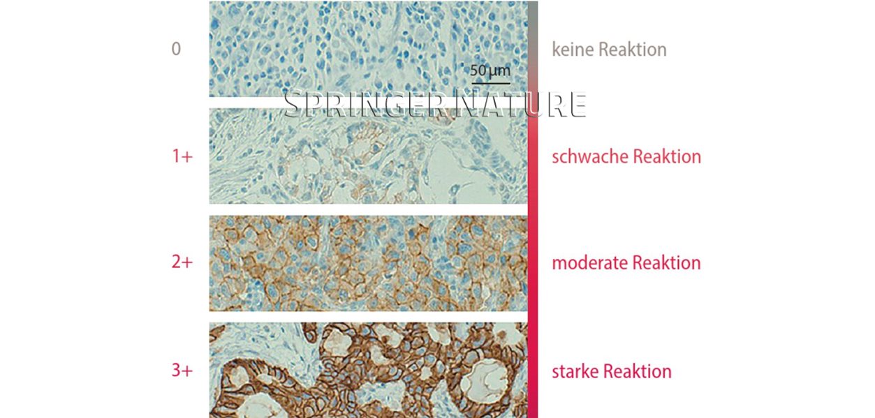 Biomarker erweitern Optionen bei Diagnostik und Therapie des ...
