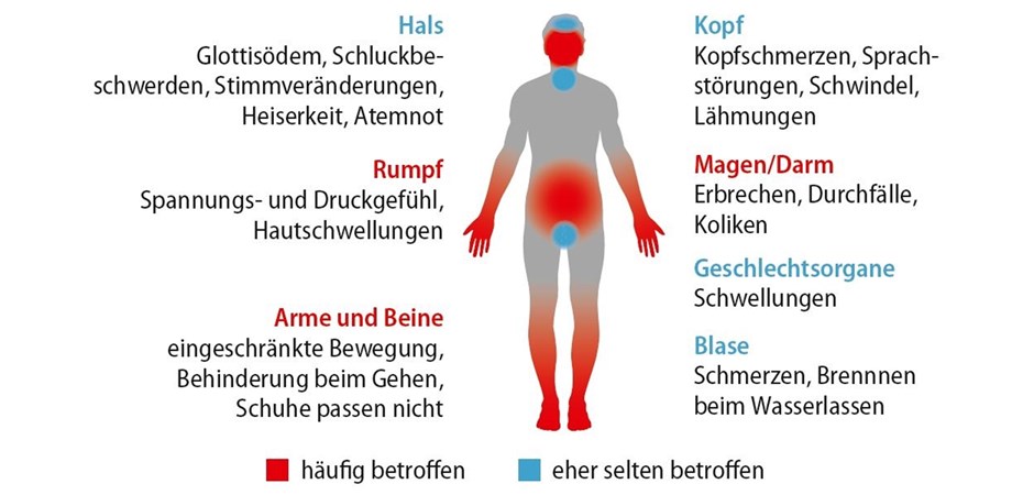 Bei episodischen Abdominalattacken auch an das hereditäre Angioödem denken