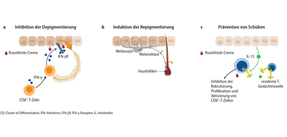 Ruxolitinib-Creme verbessert Pigmentierung bei Vitiligo