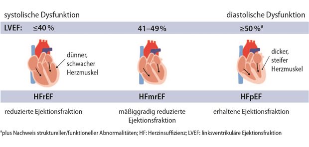 Chronische Herzinsuffizienz in der hausärztlichen Versorgung