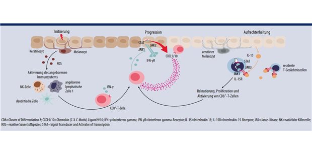 Vitiligo - eine chronische Autoimmunerkrankung mit hoher psychosozialer ...
