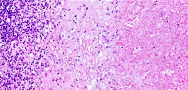 Fieber, Schüttelfrost und Schmerzen im Oberbauch nach einem „Bachfest“