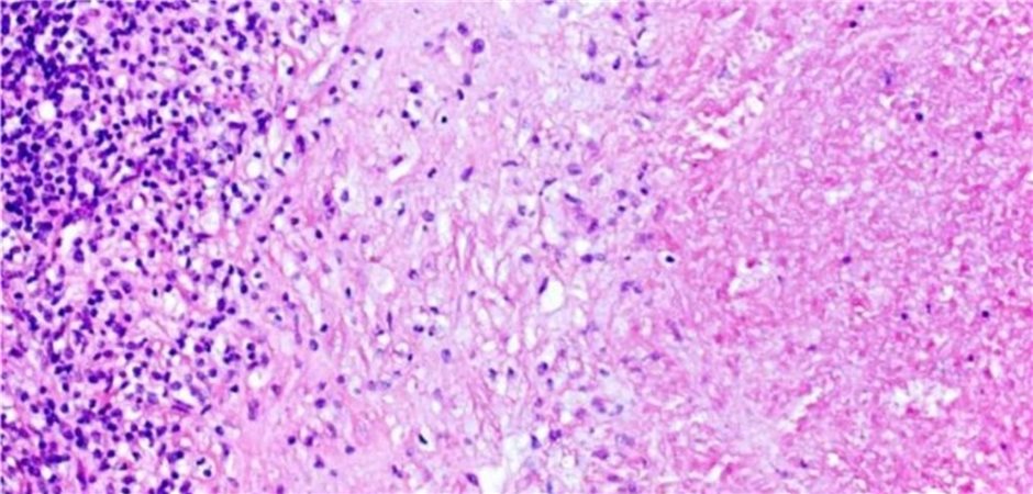 Fieber, Schüttelfrost und Schmerzen im Oberbauch nach einem „Bachfest“