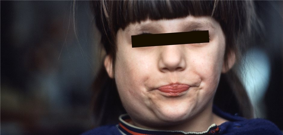 Mumps immer öfter auch bei vollständig geimpften Kindern