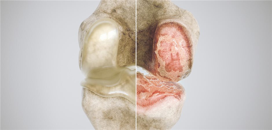 Arthrose – neue Ansätze zur Knorpelregeneration