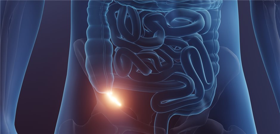 Bei unkomplizierter Appendizitis geht es auch ohne Operation