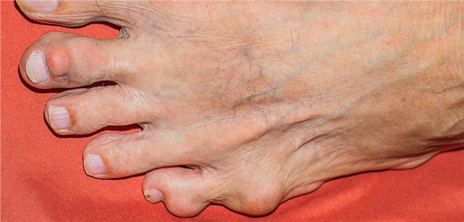 Warum schrumpfen bei manchen Gichtpatienten die Zehen?