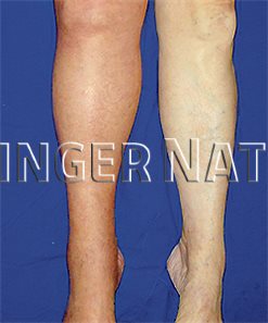 So lange sollte die Thromboseprophylaxe dauern