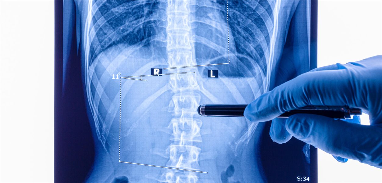 LWS-Skoliose: Betroffene profitieren offenbar nachhaltig von einer ...