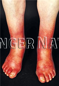 Rote "Socken" durch kranke Gefäße