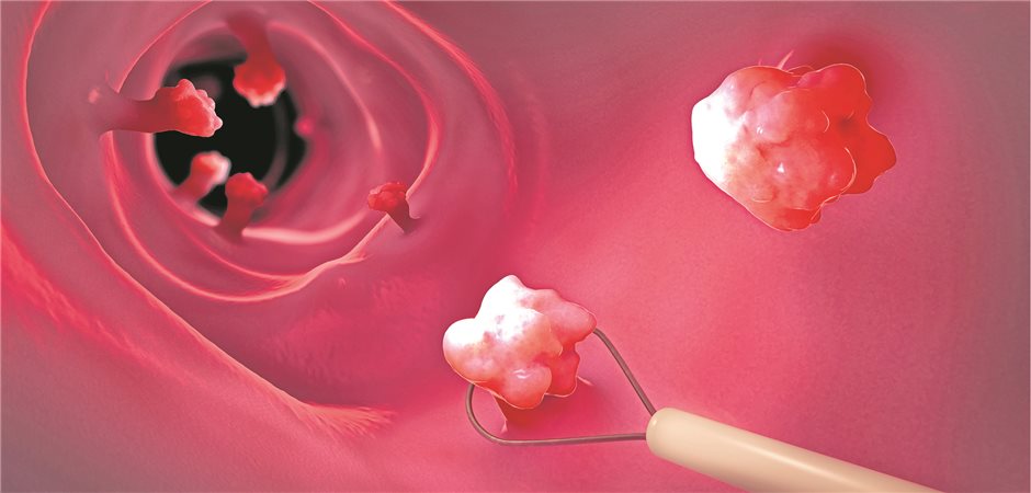 European Polyp Surveillance: Zu viele Wiederholungskoloskopien?