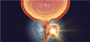 Prostatakarzinom: Molekulares Testen von Patienten wird immer wichtiger