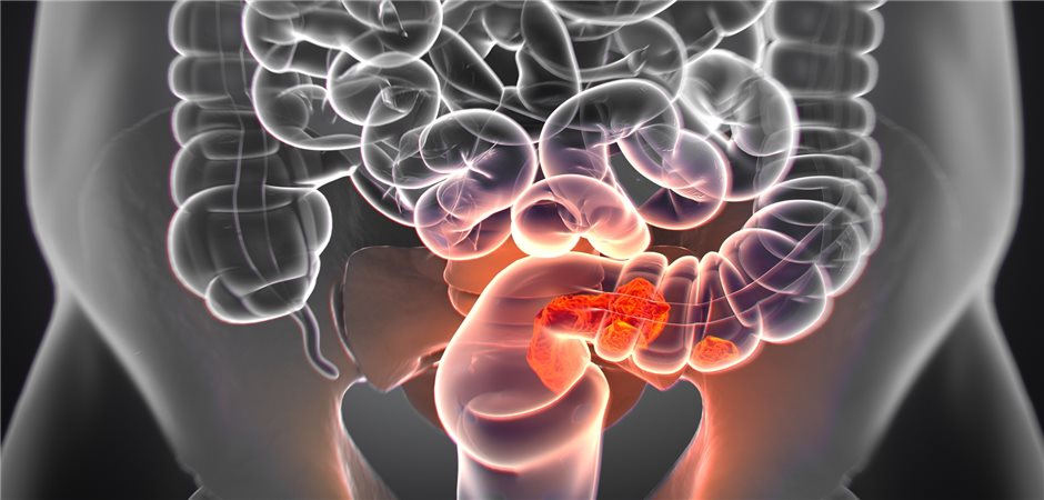 Immuntherapie bei einigen Patienten mit mCRC wohl besser als Chemo
