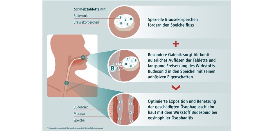 Jorveza® – erste zugelassene Therapie bei eosinophiler Ösophagitis