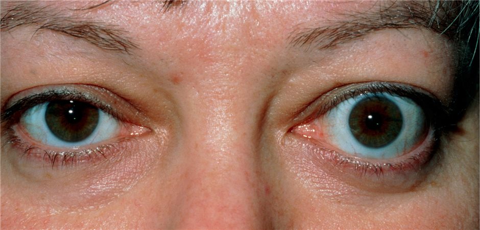 Bald neue Optionen bei endokriner Orbitopathie