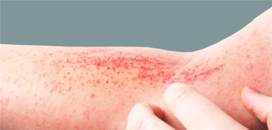 Atopische Dermatitis: mehr als trockene Haut und Juckreiz