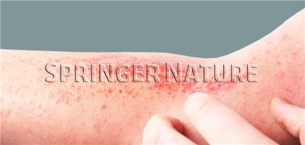 Atopische Dermatitis: mehr als trockene Haut und Juckreiz