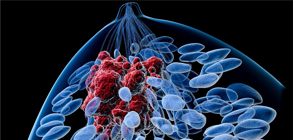 Alpelisib ist neuer Standard bei Brustkrebs und PIK3-Mutation