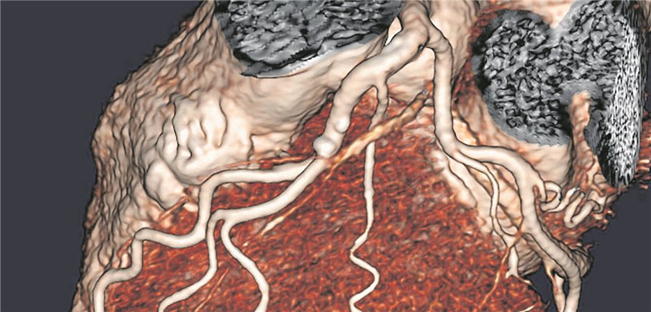 Triage mit Koronar-CT bei stabiler Angina ist sicher