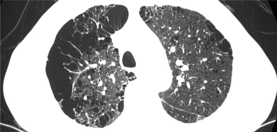 CT spiegelt die Schwere der COVID-19-Pneumonie