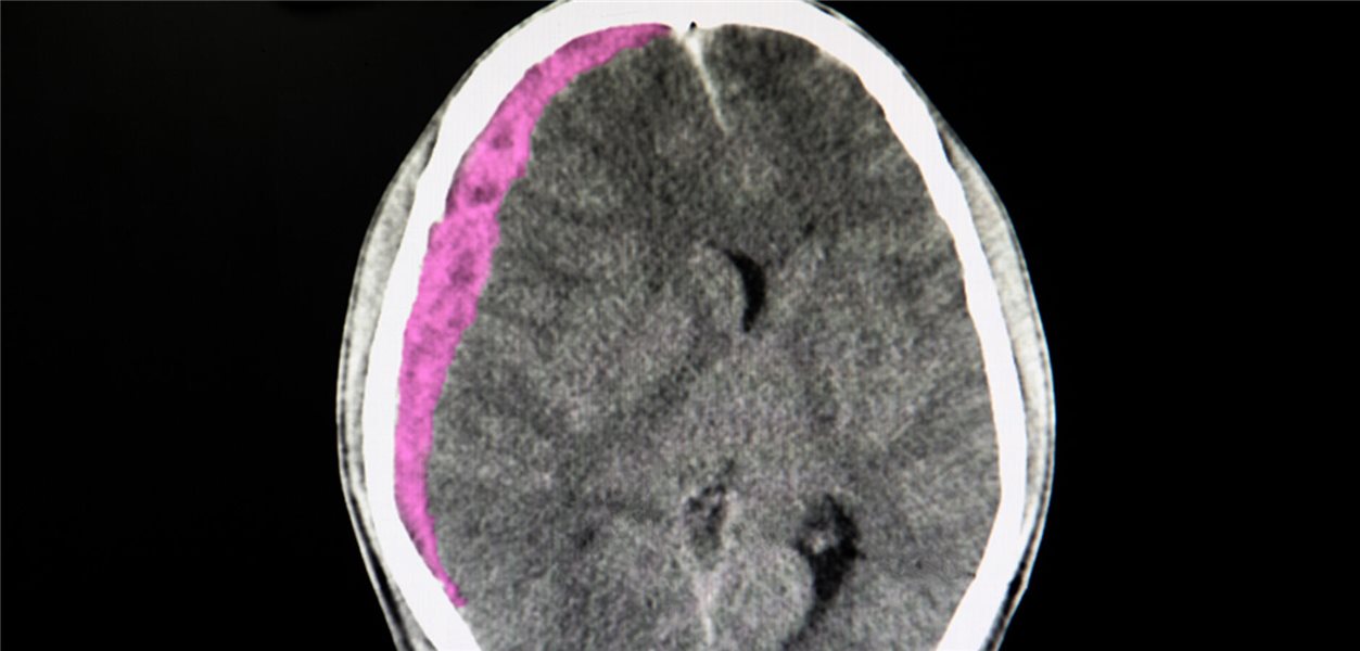 Chronisches subdurales Hämatom: Acetylsalicylsäure perioperativ ...