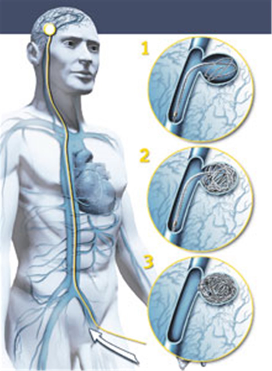Bei Blutung Clipping oder Coiling?
