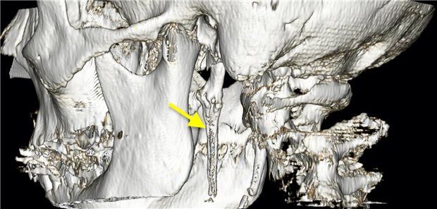 Eagle-Syndrom: Knochen, wo eigentlich kein Knochen hingehört