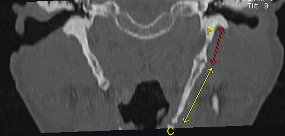 Eagle-Syndrom: Knochen, wo eigentlich kein Knochen hingehört