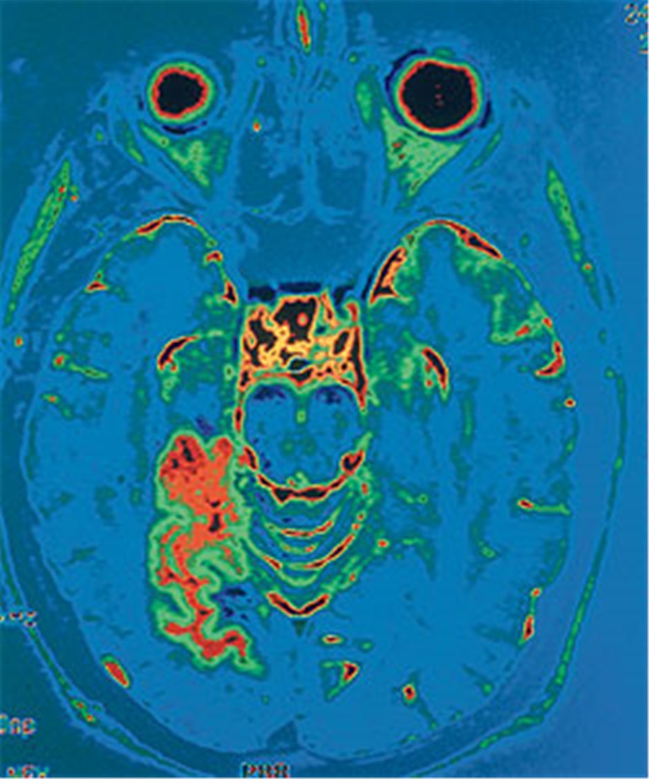 Weniger gravierende Blutungen als unter Warfarin