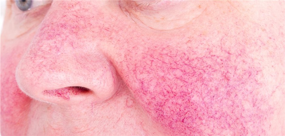 Studie: Mit der Rosazea erhöht sich das Hautkrebsrisiko