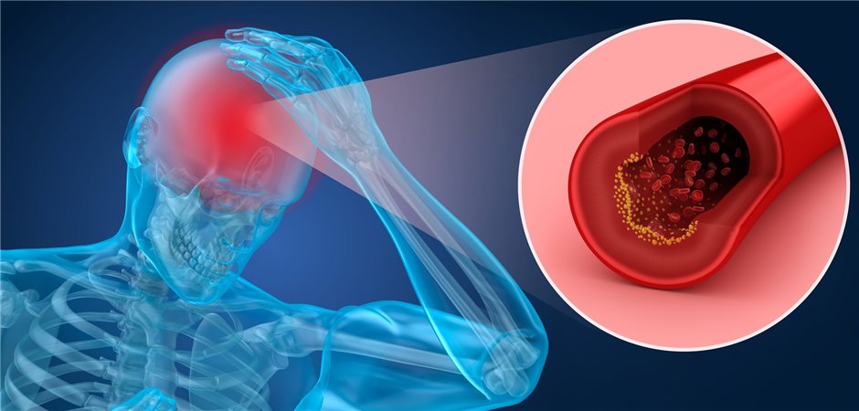 Erhöhtes Demenz- und Insultrisiko: Welche Rolle Anticholinergika spielen