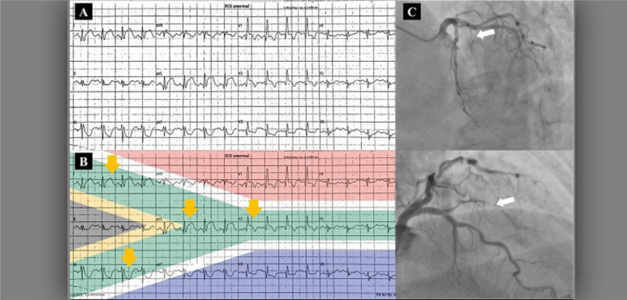 Twelve OMI EKG Criteria for Complete Coronary Closure - News Directory 3