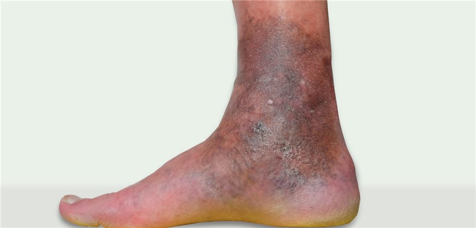 Ulcus cruris venosum erfordert rasche Kompression