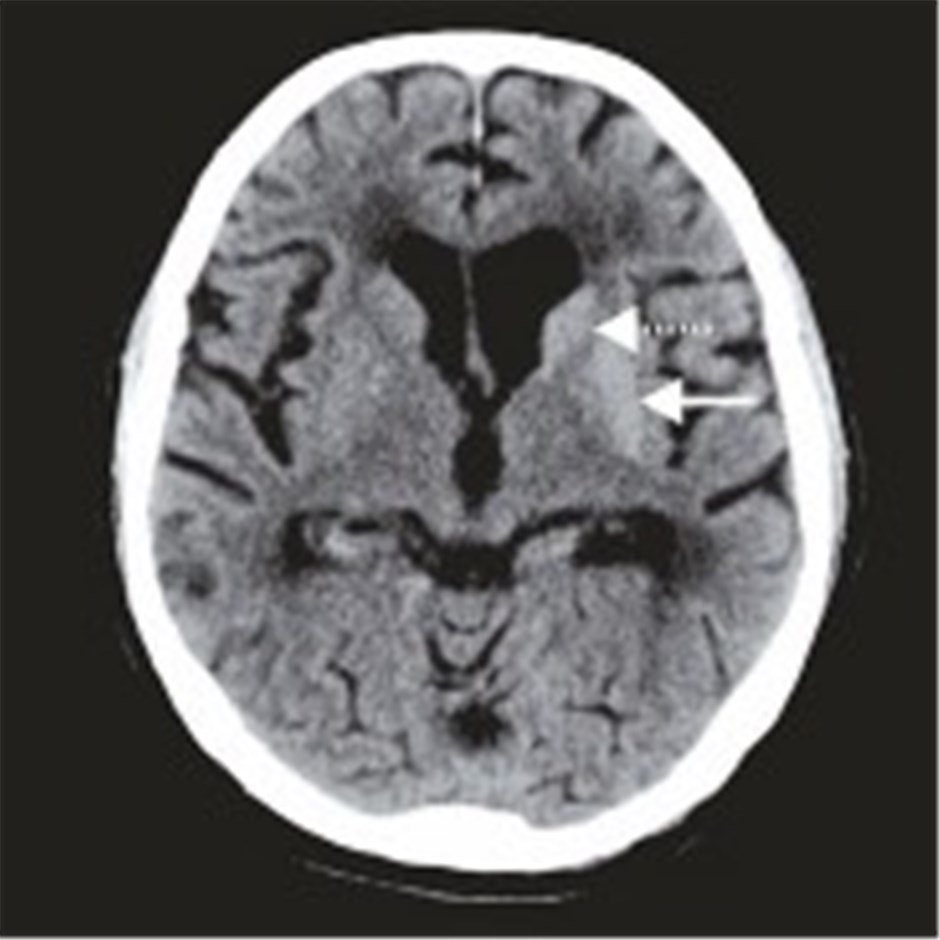 Heftige Armbewegungen - durch Diabetes
