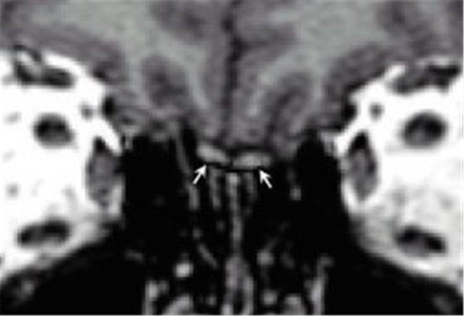 Alzheimer-Diagnostik am Riechkolben