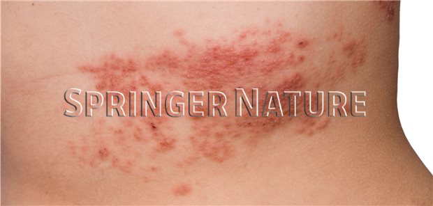 Herpes zoster-Komplikationsrisiko nicht unterschätzen!