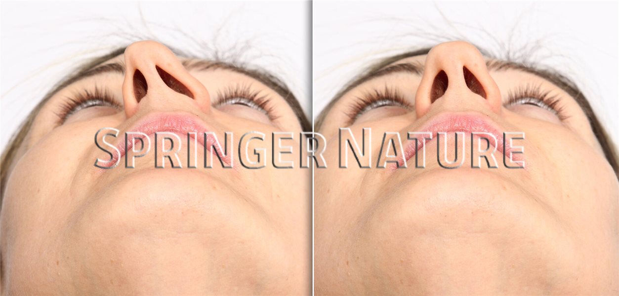 Septumplastik bei verstopfter Nase: Deutliche Besserung im NOSE-Score