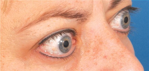 Endokrine Orbitopathie: In fünf Schritten das Sehvermögen erhalten