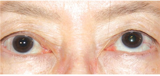 Endokrine Orbitopathie: In fünf Schritten das Sehvermögen erhalten