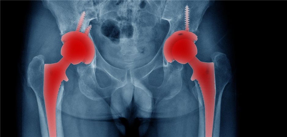 Beidseitige Hüftarthrose: Wenn schon Gelenkersatz, dann beide Seiten ...