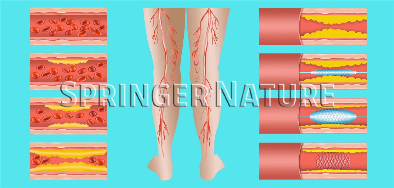 Resorbierbare Gefäßgerüste punkten bei schwerer PAVK