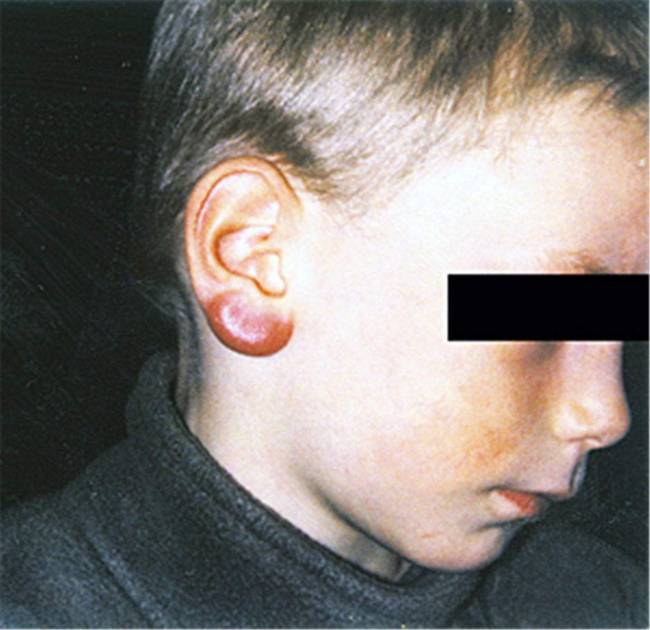 Rotes Ohrläppchen durch Borrelien-Infektion