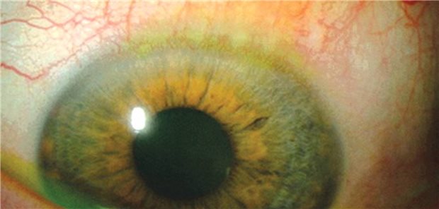 Endokrine Orbitopathie: In fünf Schritten das Sehvermögen erhalten