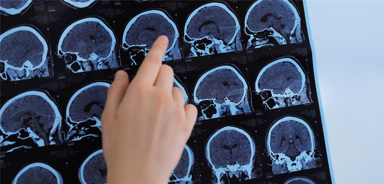 Benigne Multiple Sklerose bleibt wohl meist langfristig stabil