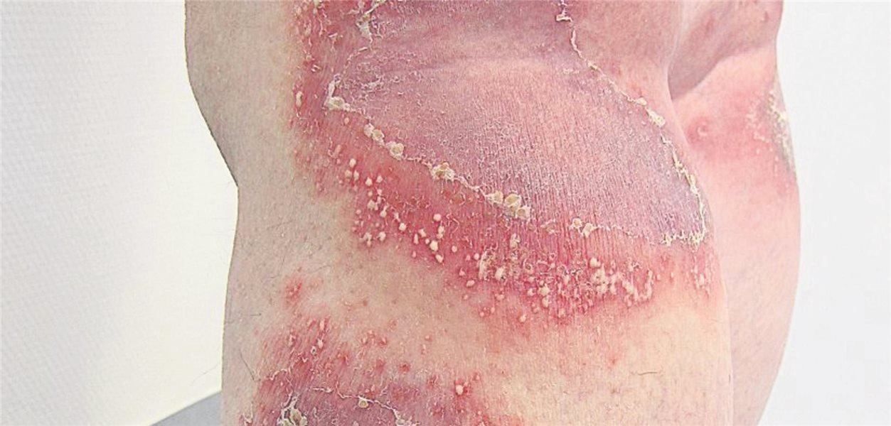 Psoriasis pustulosa: Neue Therapieansätze in Erprobung