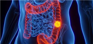 Bessere Prognose mit links- statt rechtsseitigem Kolonkarzinom