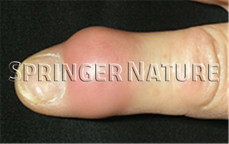 Gichtmittel zeigt bei Herzinsuffizienz positive Seiten