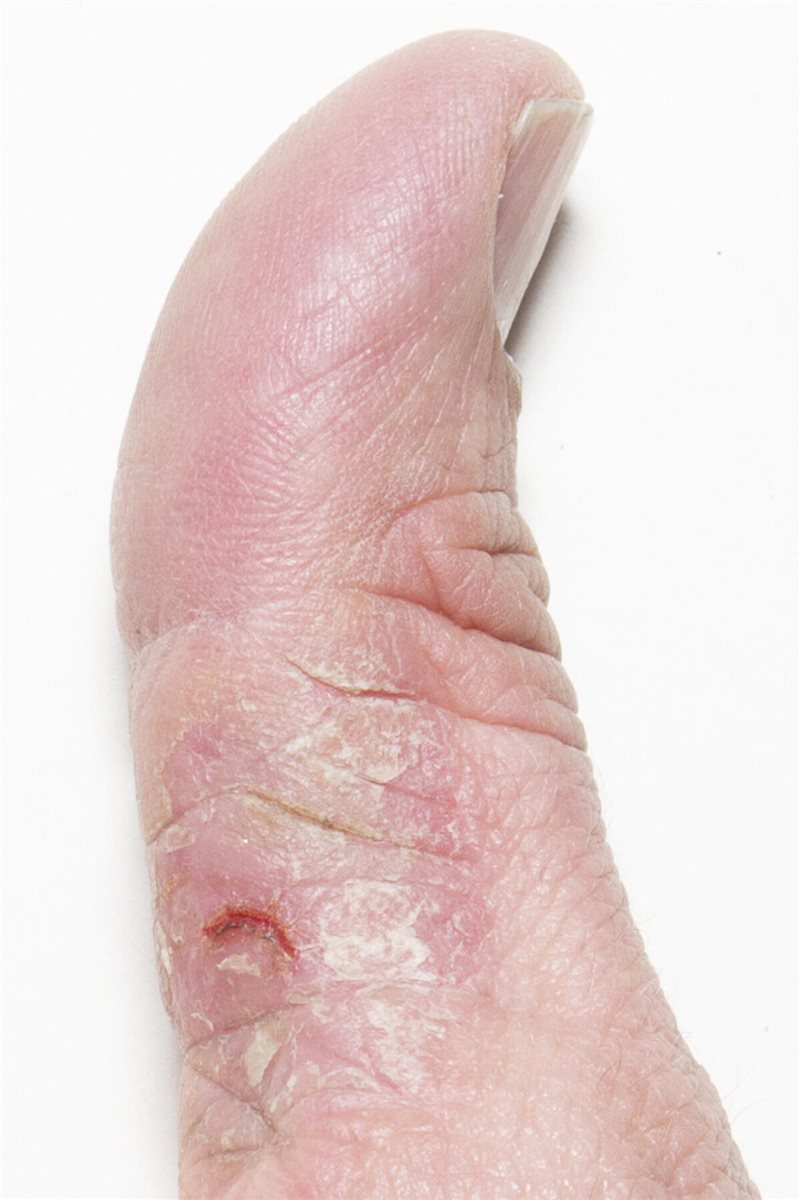 Tipps zu Rhagaden: Das Kreuz mit den Rissen in der Haut