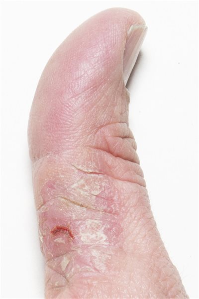 Tipps zu Rhagaden: Das Kreuz mit den Rissen in der Haut